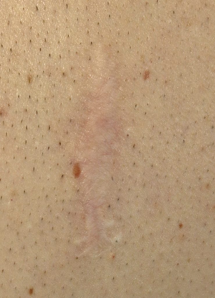 Narbenbehandlung - Ergotherapie Andrea Hofer